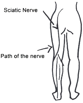 Sciatic Nerve Pain Diagram Sciatic Nerve Hip Pain | Sciatica Pain